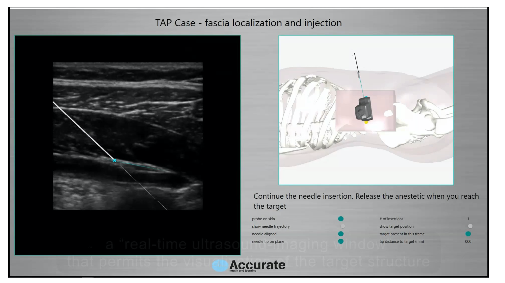 Simulateur de blocs nerveux échoguidés - BlockSim | Twin Medical